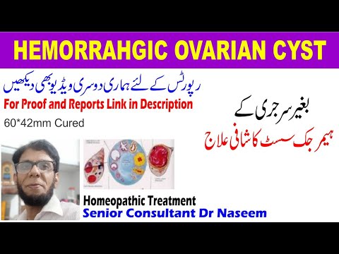 Hemorrhagic Ovarian Cyst ka ilaj homeopathic !| Hemorrhagic Ovarian cyst treatment in urdu