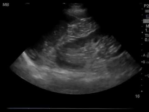 SonoTutorial: The FAST Part 2a: Left Upper Quadrant – Images that could ...