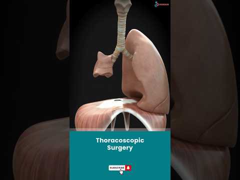 Video-Assisted Thoracoscopic Surgery (VATS)↪3D Medical Animation #Shorts #ThoracoscopicSurgery #VATS