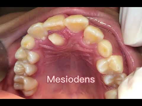 Supernumerary tooth extraction (Mesiodens)