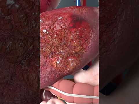 Watch What Happens To Your Body When You Use Steroids