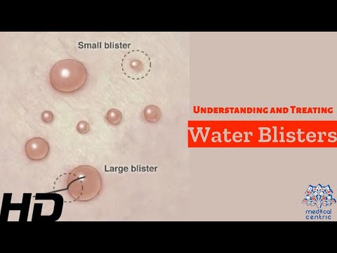 Water Blisters Unveiled: Causes, Treatment, and Prevention