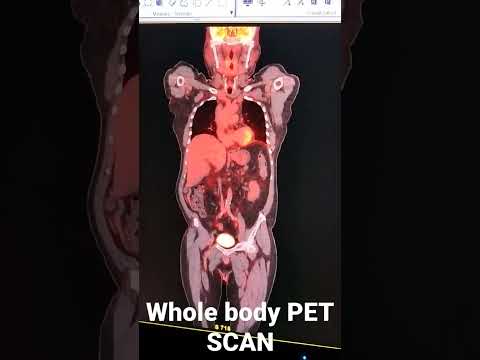 PET SCAN
