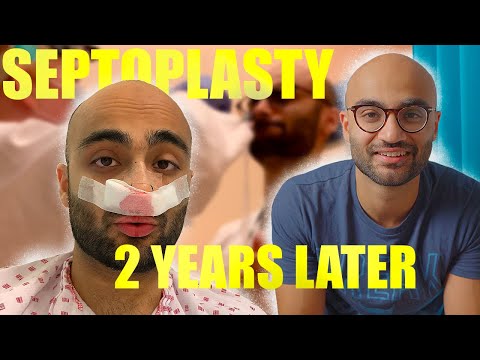 Septoplasty UPDATE 2 years later | Was the Pain worth it?