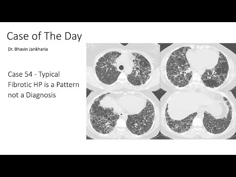 Case of the Day - 054 - 2025 06 18 - Typical Fibrotic HP on CT is a Pattern, Not a Diagnosis