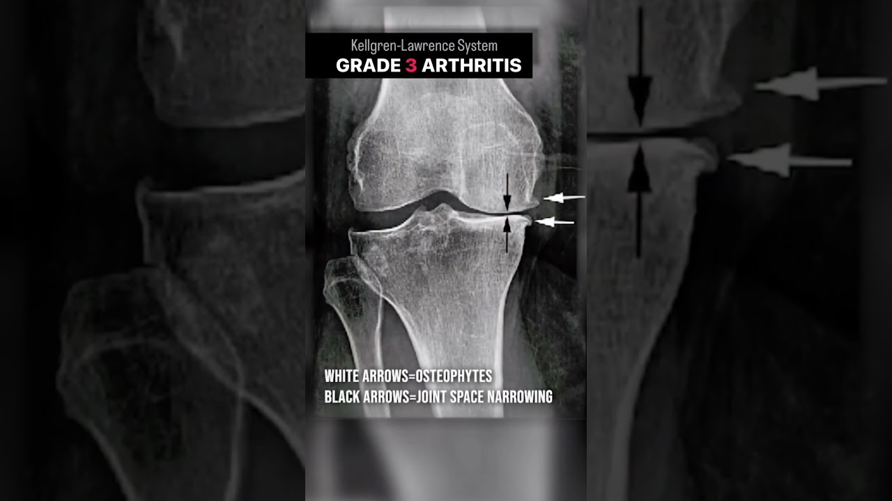 Knee Arthritis Grades 0 to 4 Explained — The Kellgren-Lawrence Scale #shorts