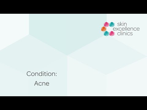 How can I treat acne?