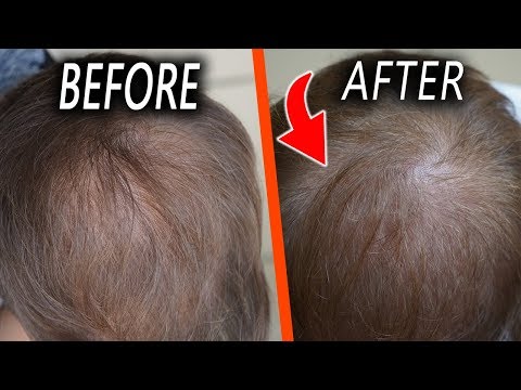 Topical Finasteride - 1 month Update! Only one side effect...