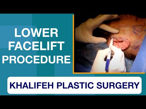 Lower Facelift Procedure | Khalifeh Plastic Surgery