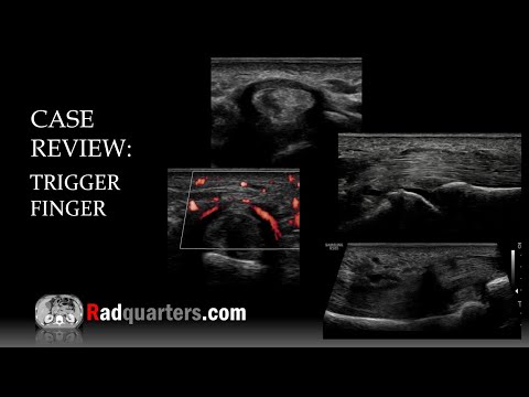 Ultrasound of Trigger Finger (Stenosing Tenosynovitis)