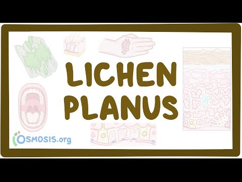 Lichen planus - causes, symptoms, diagnosis, treatment, pathology