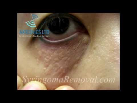 What is syringoma?