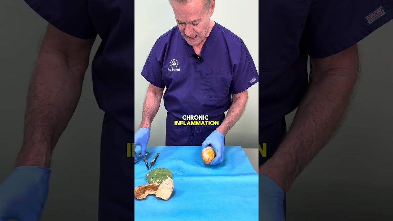Ruptured Breast Implant #breastimplantsurgery #implantremoval #plasticsurgeon