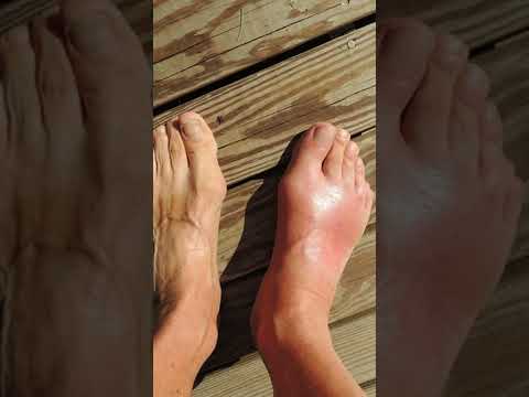 Gout Kya Hota Hai Or Iska ilaj Kya Hai | Health Hacks And Tips | Health Tips in Urdu