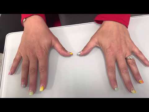 Thumb CMC joint replacement
