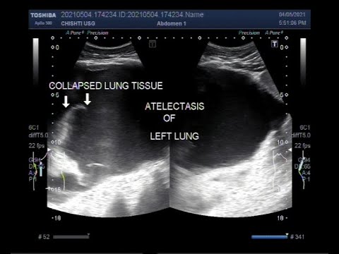 Atelectasis, large Pleural Effusion with Collapsed lung tissue.