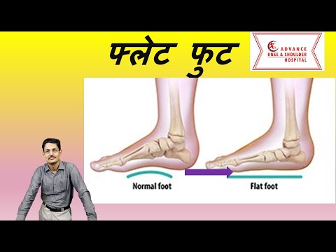 Flat Foot in Hindi फ्लैट फुट