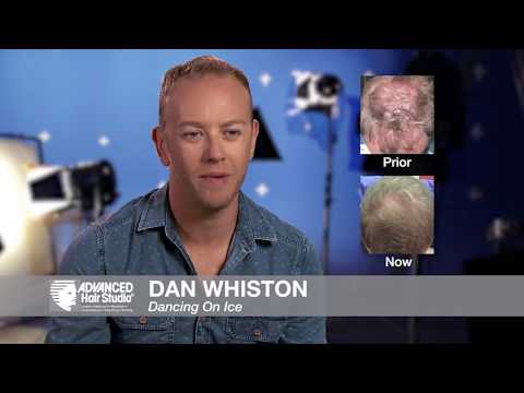 Advanced Hair Studio 'Real stories' of Hair regrowth and replacement