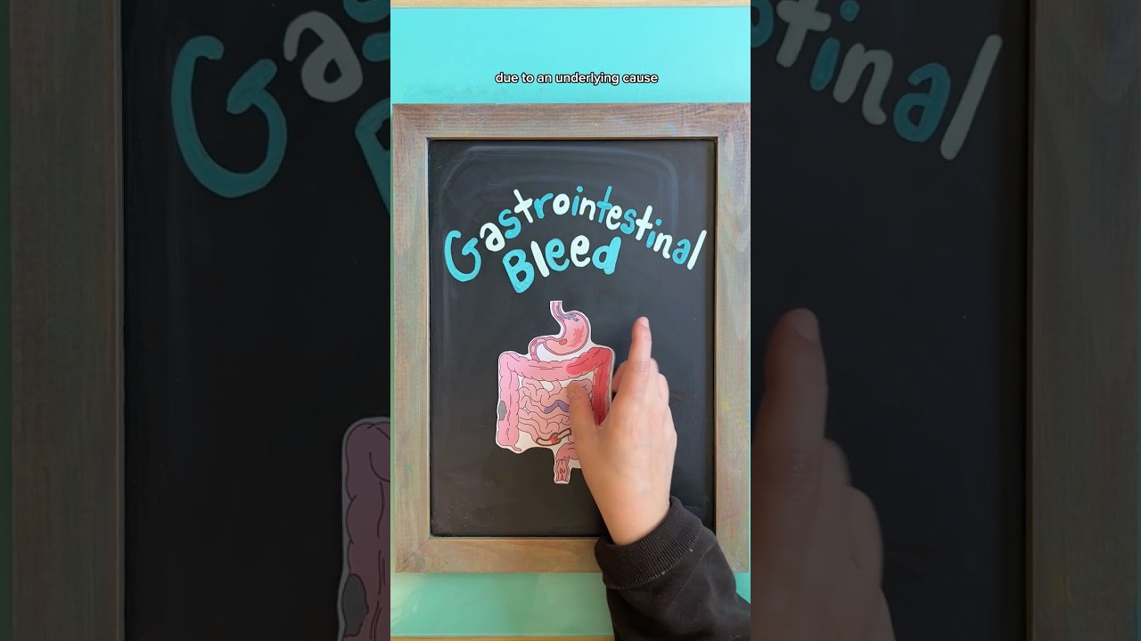 GI BLEED Overview for Nursing Students #nursingstudents