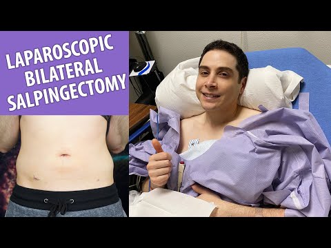 I Got Sterilized! My Experience & Recovery | Laparoscopic Bilateral Salpingectomy