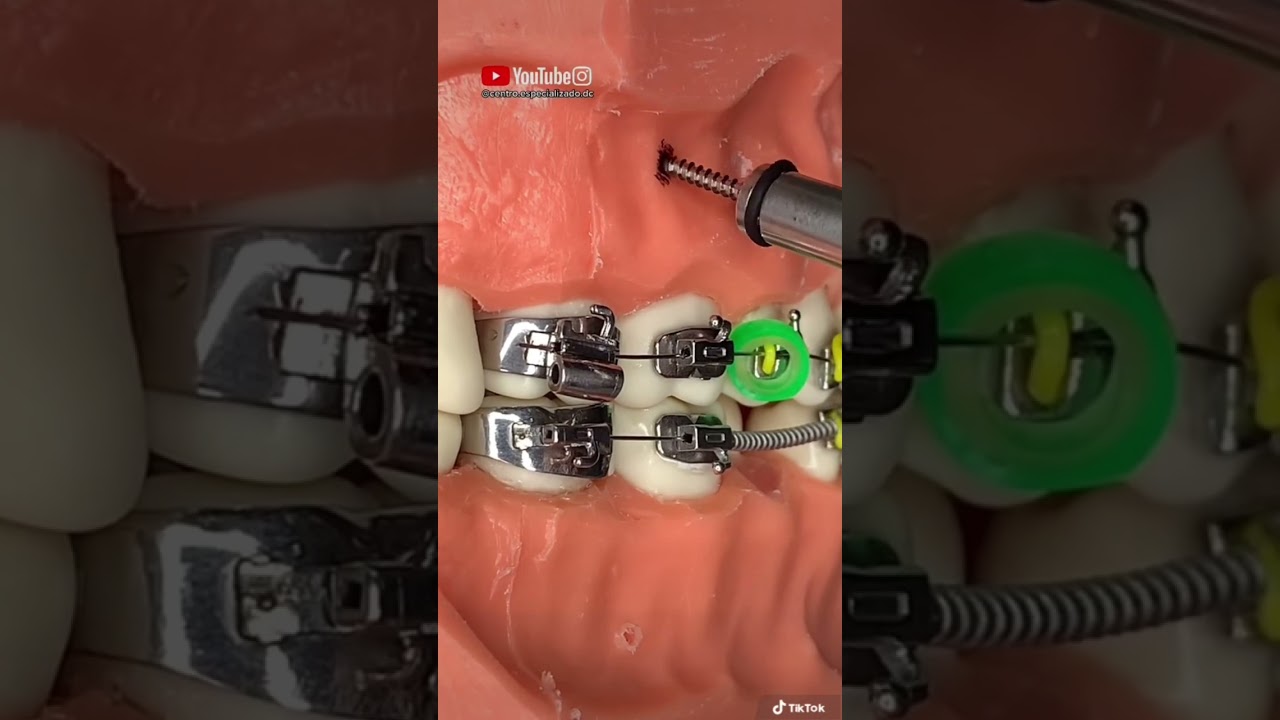 ¡EN EL HUESO! Instalación de micro-tornillos.