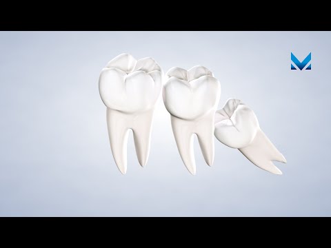 Post-Operative Instructions: Wisdom Teeth Removal in Ann Arbor, Adrian, Dexter, and Plymouth, MI