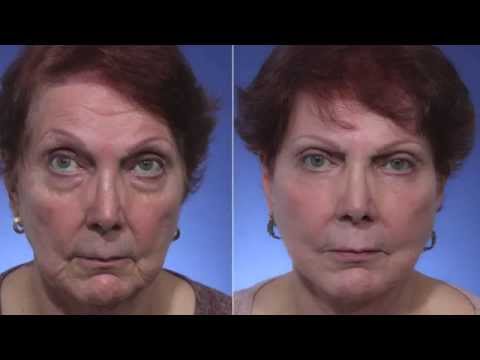 Facelift and Facial Rejuvenation in South Florida