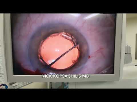 Optic capture technique for dislocated sulcus IOL