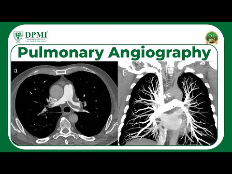 Pulmonary Angiography: Indications, Techniques & Results? What Is Pulmonary Angiography Used For?