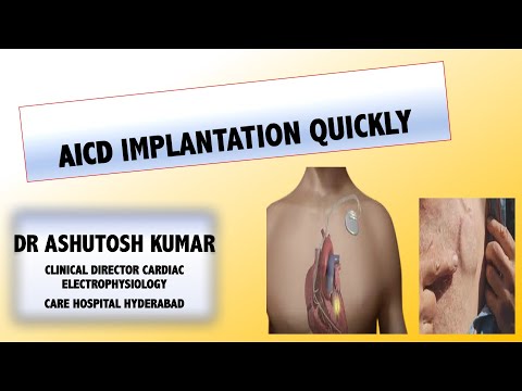 Automatic Implantable Cardioverter Defibrillator (AICD) Implantation-How it is implanted ?