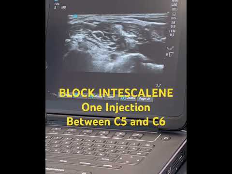 #anesthesia BLOCK INTERSCALENE NYSORA STYLE 1 Injection between C5-C6