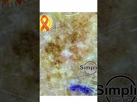 Lentigo Maligna Melanoma Dermoscopy