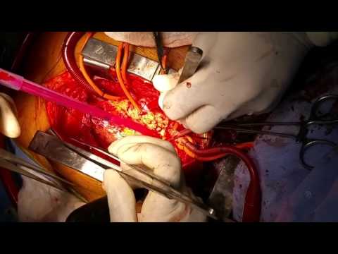 Complex Redo Reconstruction of Whole Pulmonary Artery