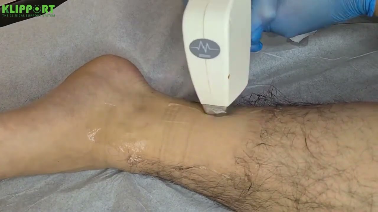 How Diode Laser Hair Removal Machine Works | Full Body Laser Treatment clinic | Klipport #klipport