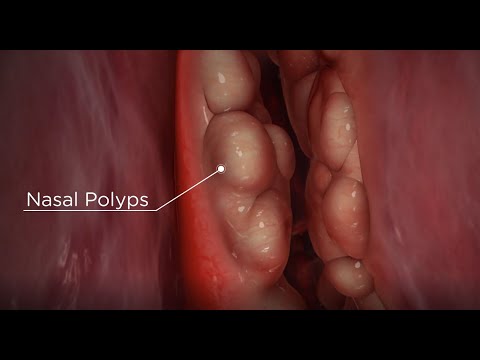 Nasal Polyps: diagnosis and treatment options