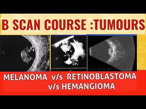 Bscan course || Differentiating choroidal melanoma from retinoblastoma and choroidal hemangioma