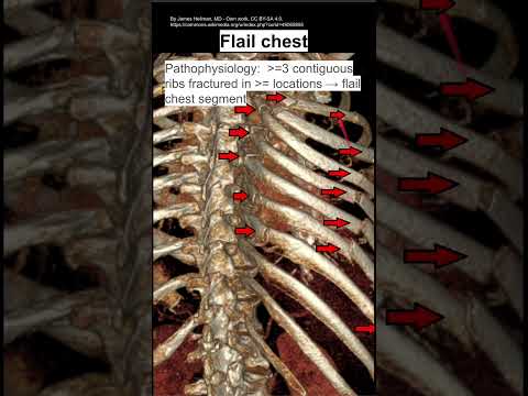 Flail chest