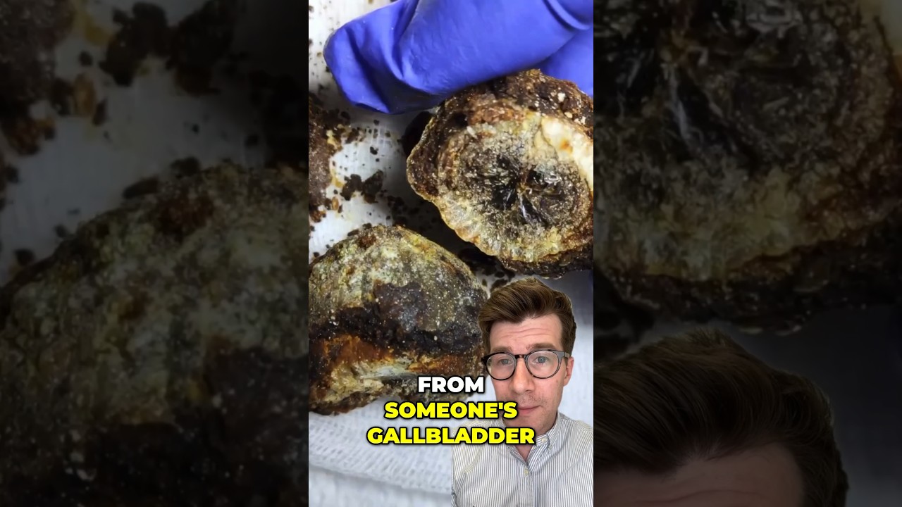 Gallstones explained #shorts #gallstones