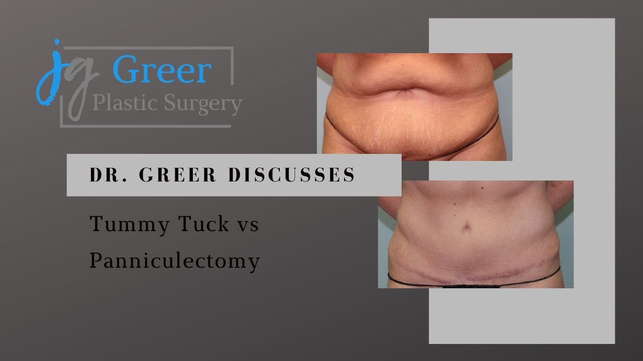 Tummy Tuck vs  Panniculectomy | Greer Plastic Surgery | Cleveland, OH
