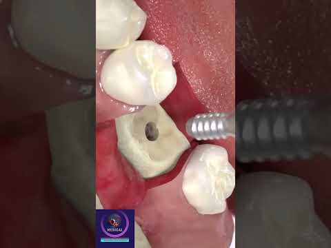 Dentistry - Implant surgery