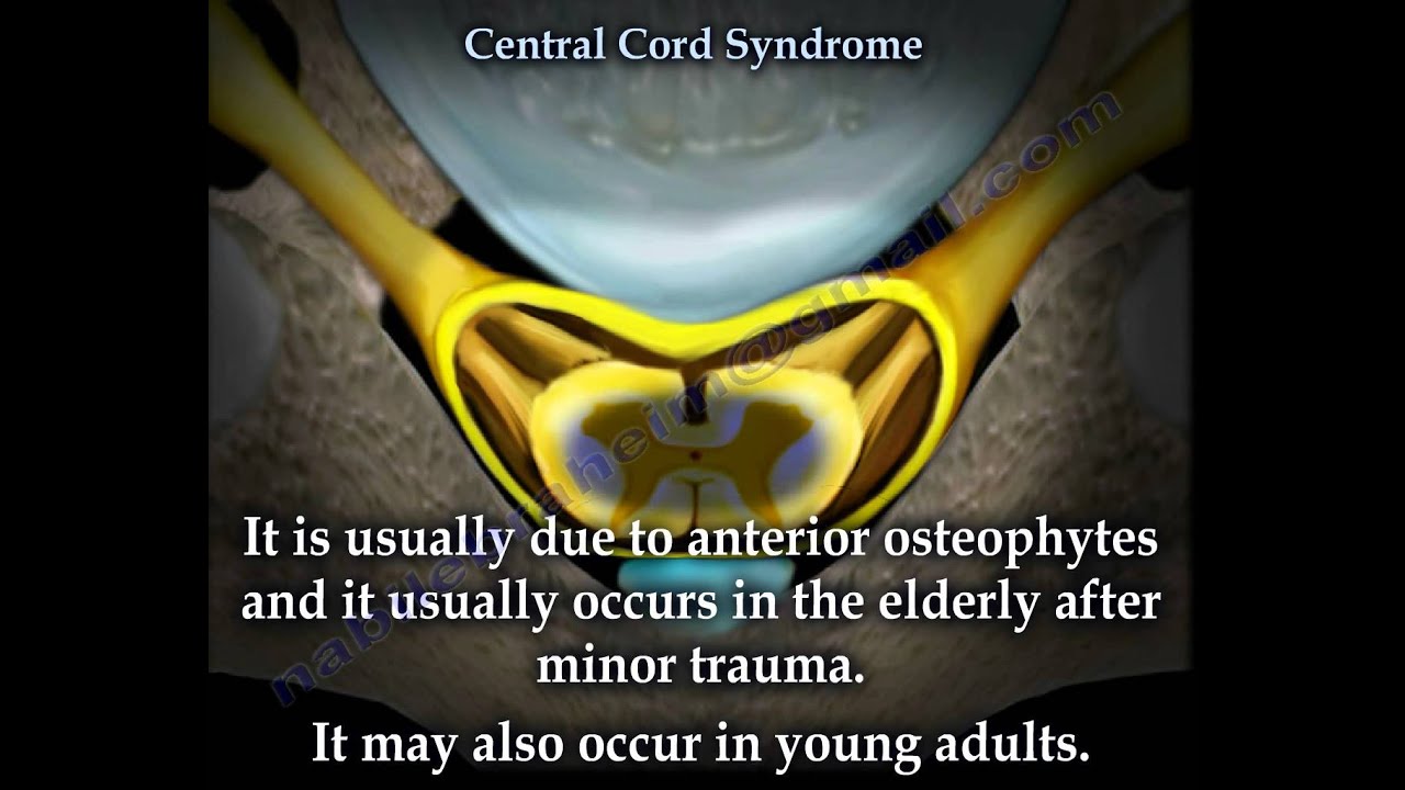 Central Cord Syndrome - Everything You Need To Know - Dr. Nabil Ebraheim