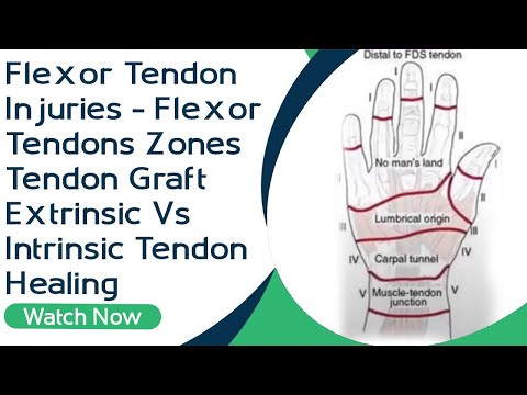 Flexor Tendon Injuries | Flexor Tendons Zones | Tendon Graft | Extrinsic Vs Intrinsic Tendon Healing
