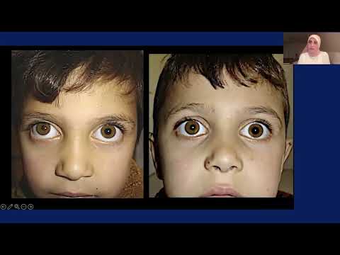 Lecture: Management of Persistent Fetal Vasculature in Children