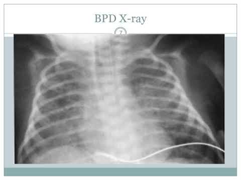 Shenfield_Bronchopulmonary Dysplasia