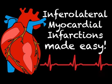 EMS Cardiology || Tachy Tuesday: Inferolateral MIs in EMS