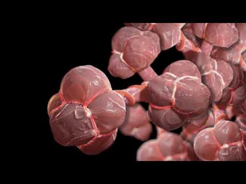 What is pneumonia?