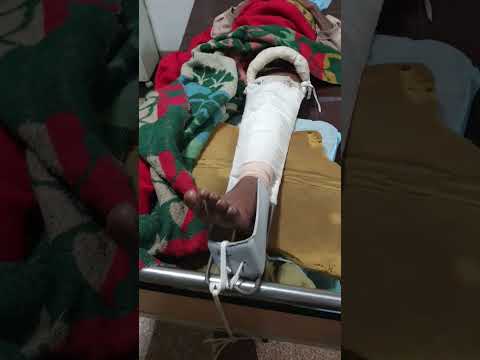 Thomas Splint #tcml #shorts
