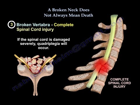 Cervical spine fracture,neck fracture - Everything You Need To Know - Dr. Nabil Ebraheim