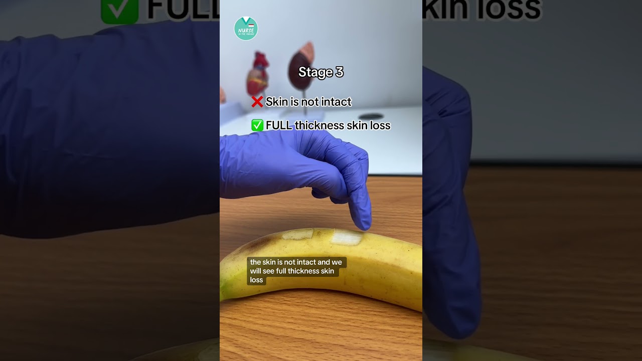 Pressure Injury Stages Made Easy🍌 #RN #BSN #futurenurse