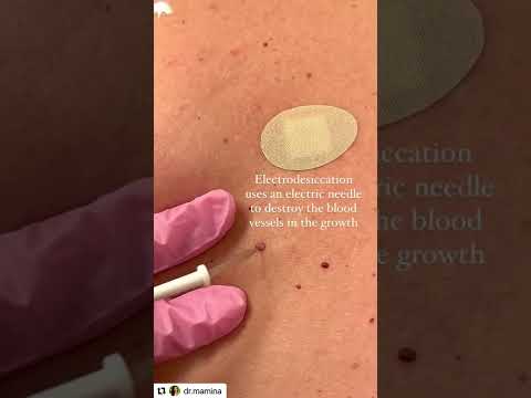 Burning a Cherry Angioma 🍒